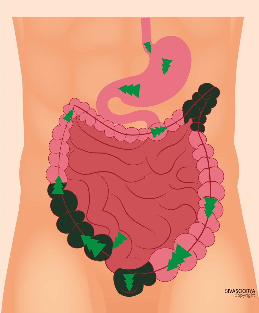 gastritis treatment and medicine in ayurveda - Ayurveda healing ashram ...